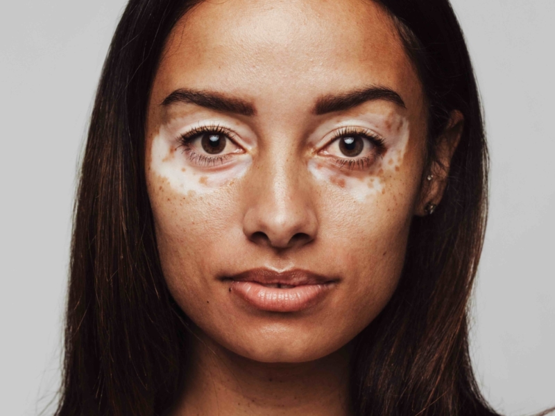 Vitiligo Treatments | Diagnosis & Next Steps | Vitiligo Society