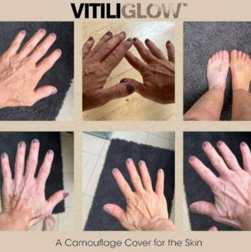 Our community nominate their top 3 cosmetic camouflage products for ...