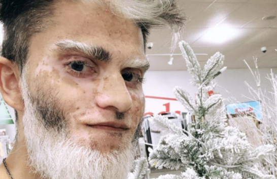 "I shared my story and embraced my identity" - The Vitiligo Society