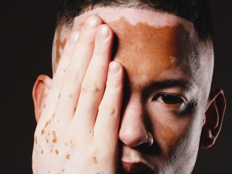 Perfecting your skincare regime when you have vitiligo - The Vitiligo ...