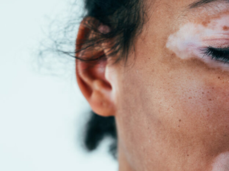 The relationship between vitiligo and skin cancer - The Vitiligo Society