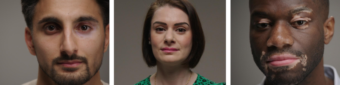 Let's Talk Vitiligo - The Vitiligo Society