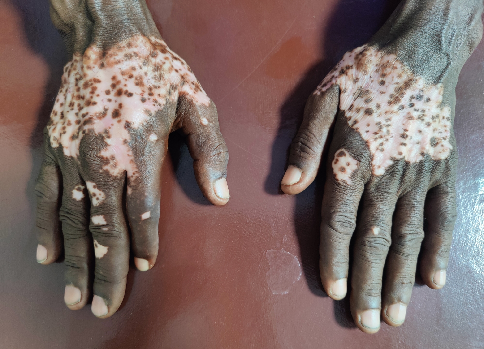 Vitiligo & ReCell® System Technology and Spray-On-Skin™ - The Vitiligo ...