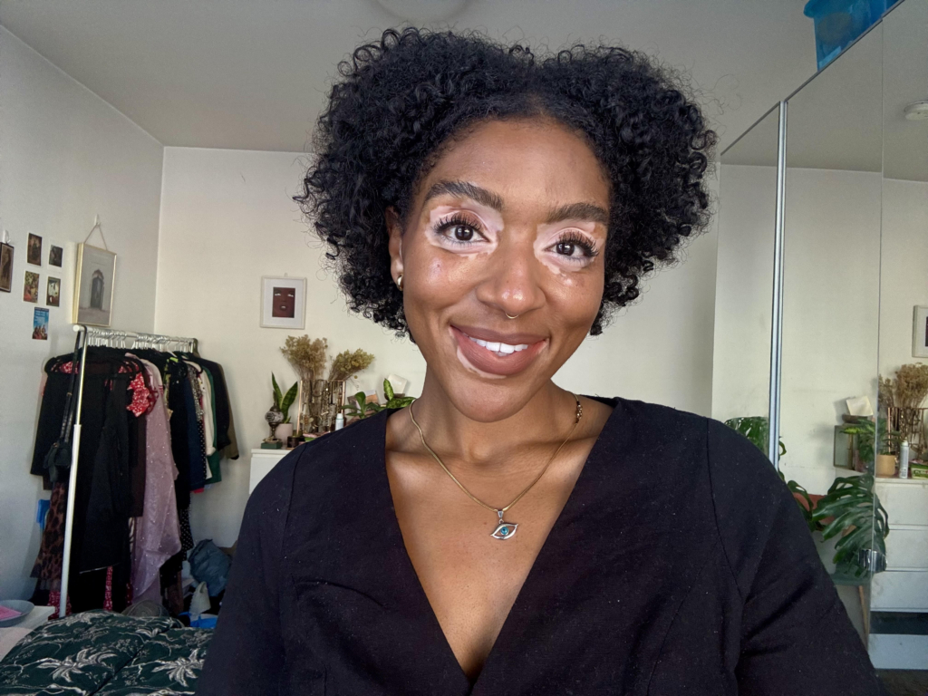My Vitiligo Journey: From Camouflage Queen to Beauty Queen - The ...